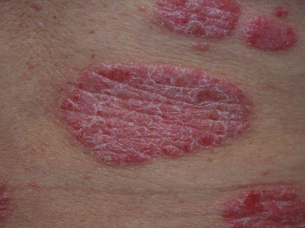 Psoriasis Diagnosis and Treatment by Dr. Naomi Goldstraw - Devon ...